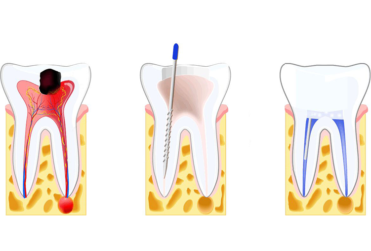 The Ultimate Guide to Endo Instruments and Endo Pluggers